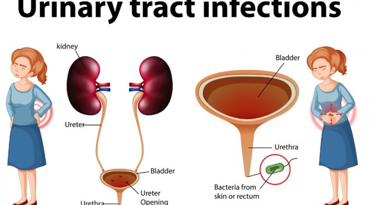 Urinary Tract Infections Utis Causes Symptoms And Treatment Coupoly